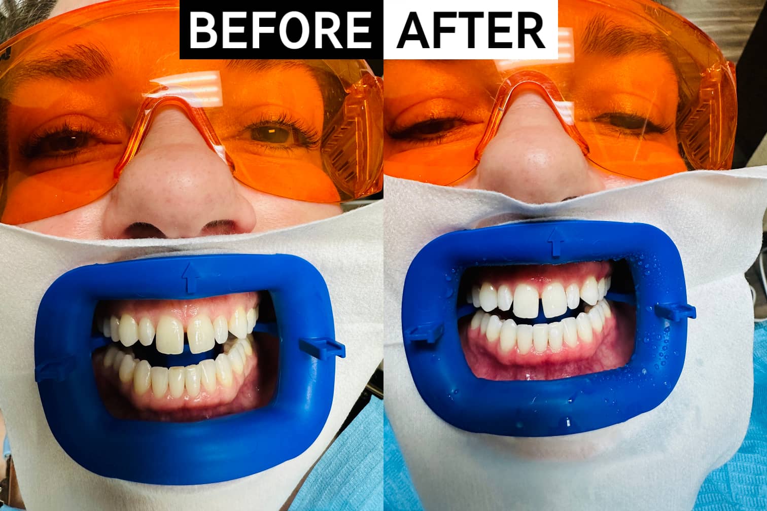 Professional Teeth Whitening Yuma - Get White Teeth Fortuna Foothills ...